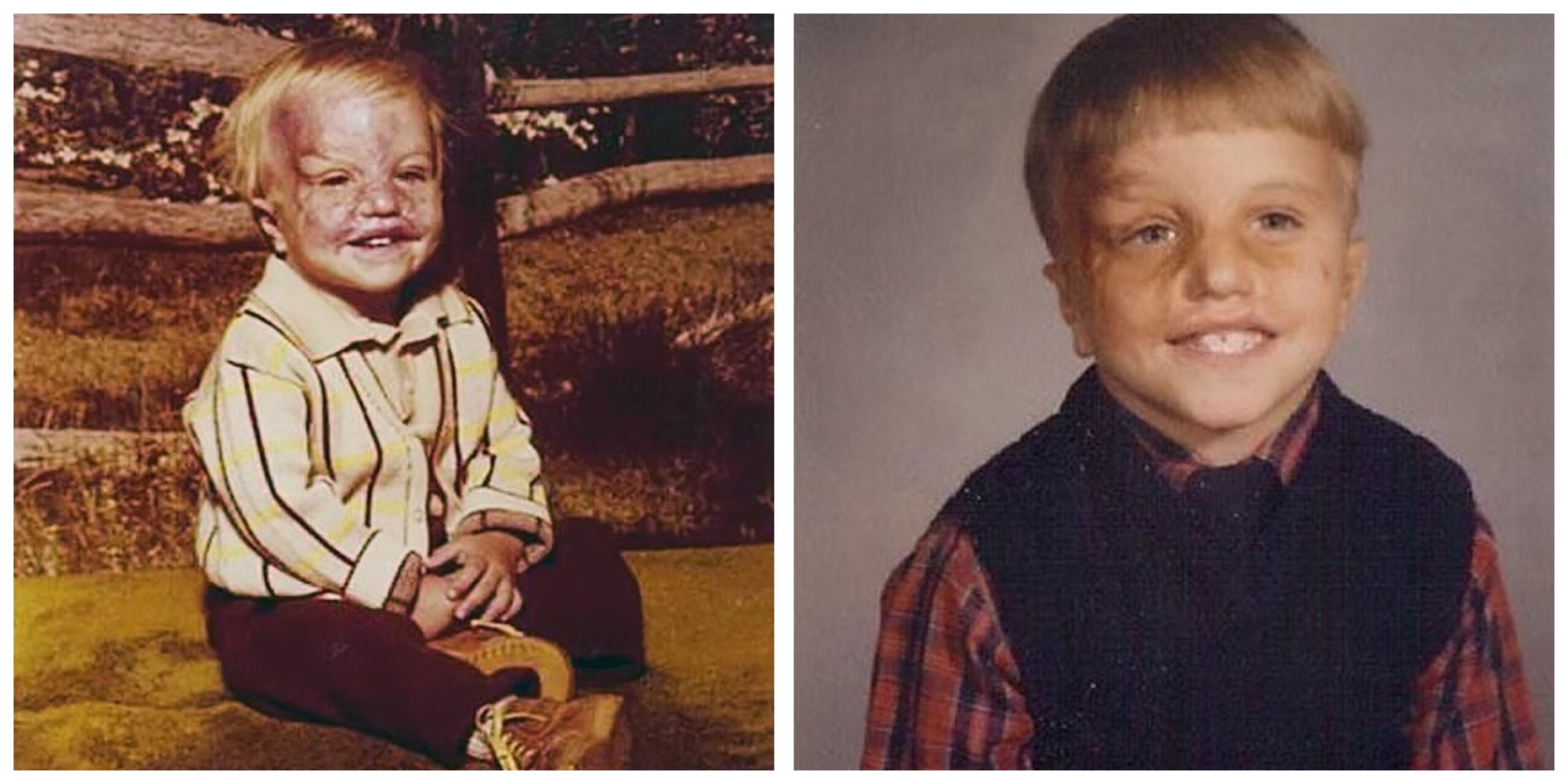 From Scars to Strength: Keith Edmonds’ Incredible Journey